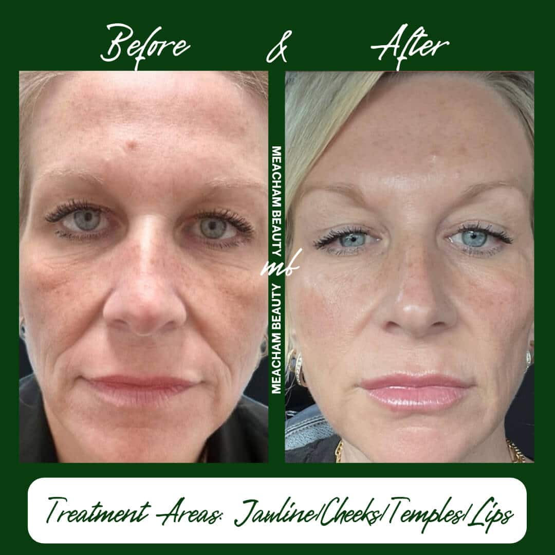 Before and After - Meacham Beauty